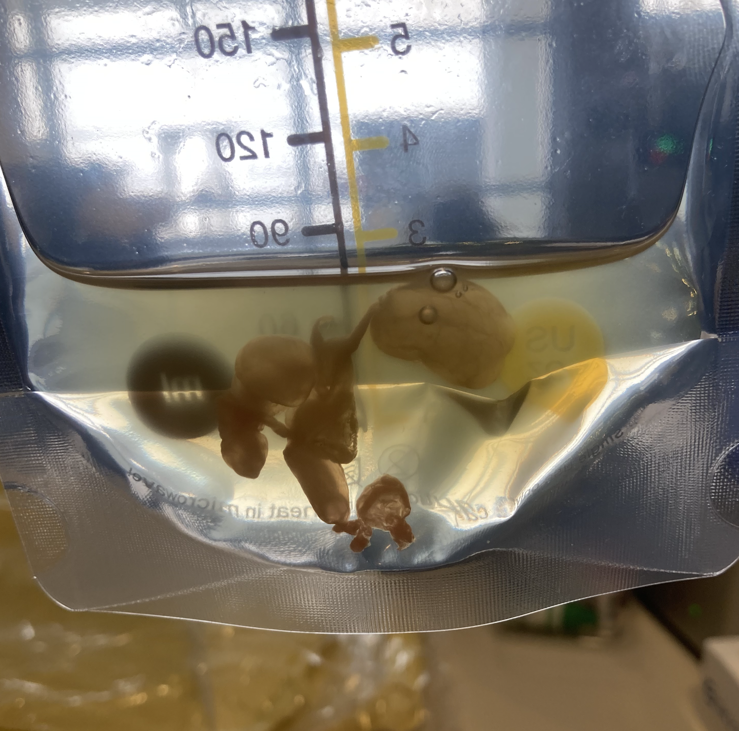 “Fat Globules” in Milk - Physician Guide to Breastfeeding